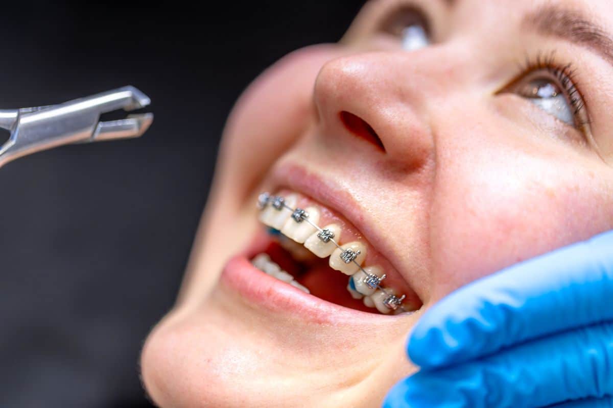 How Braces Can Change Your Face Shape: Fact or Myth?